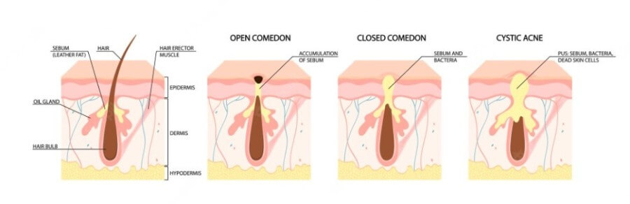 What is a Closed Comedone and How to Prevent Them - Reviva Labs