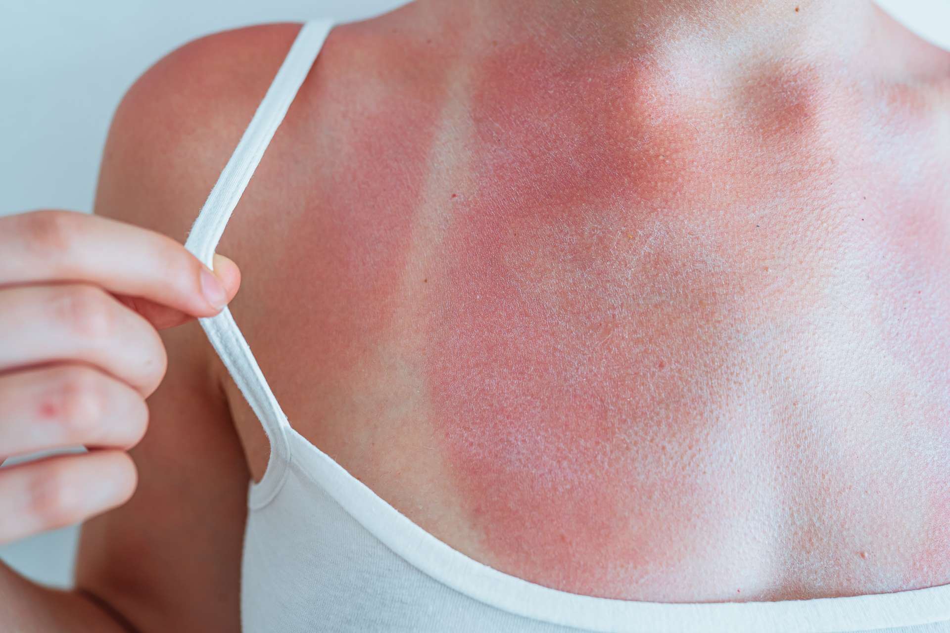 How to Treat Sunburns - Reviva Labs