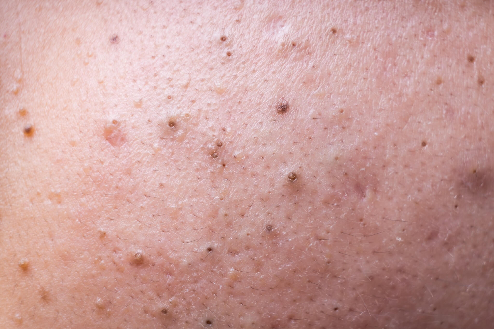 The Difference Between Sebaceous Filaments and Black Heads and How Deal ...