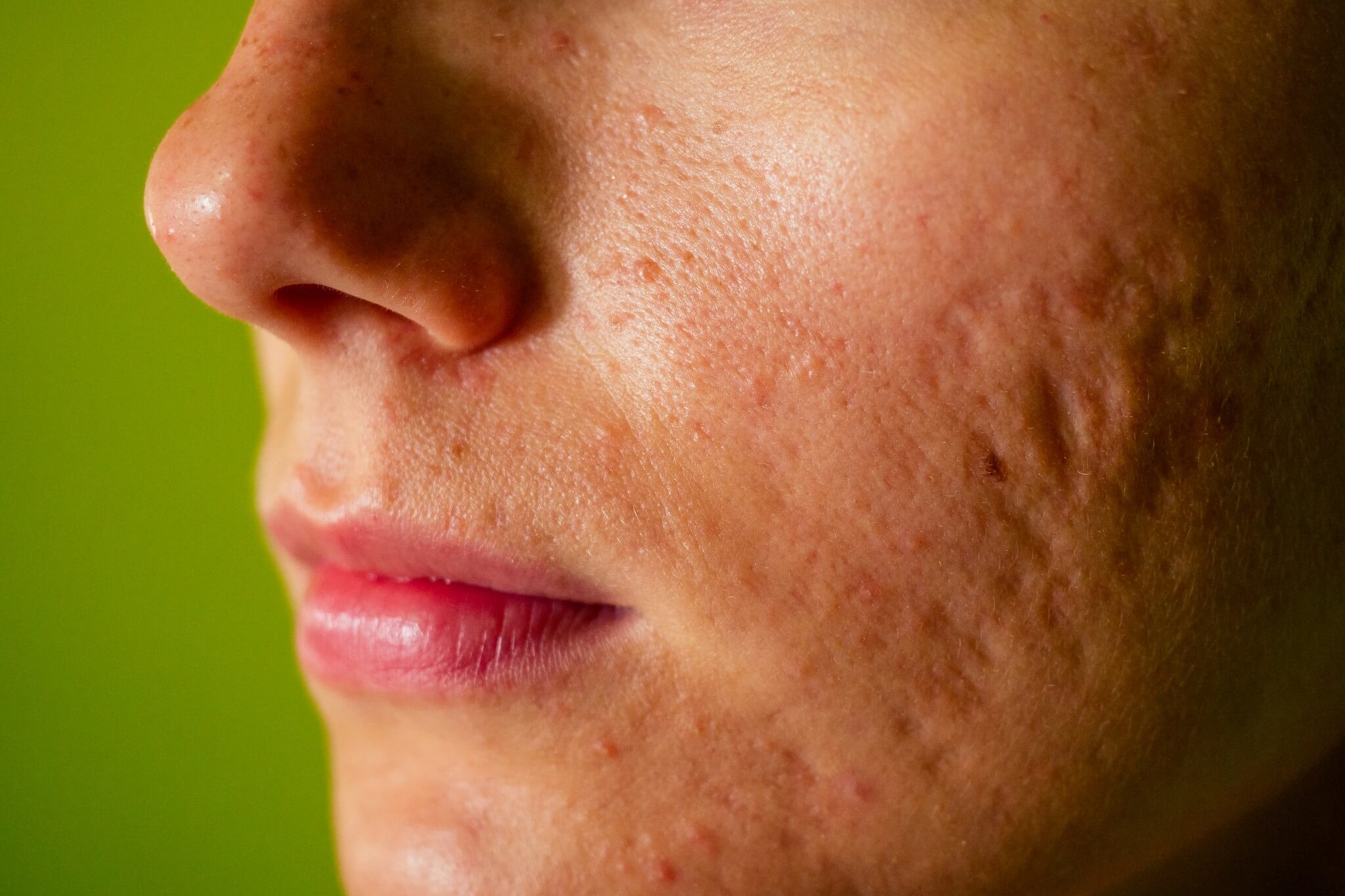 Understanding Acne Scars - Reviva Labs