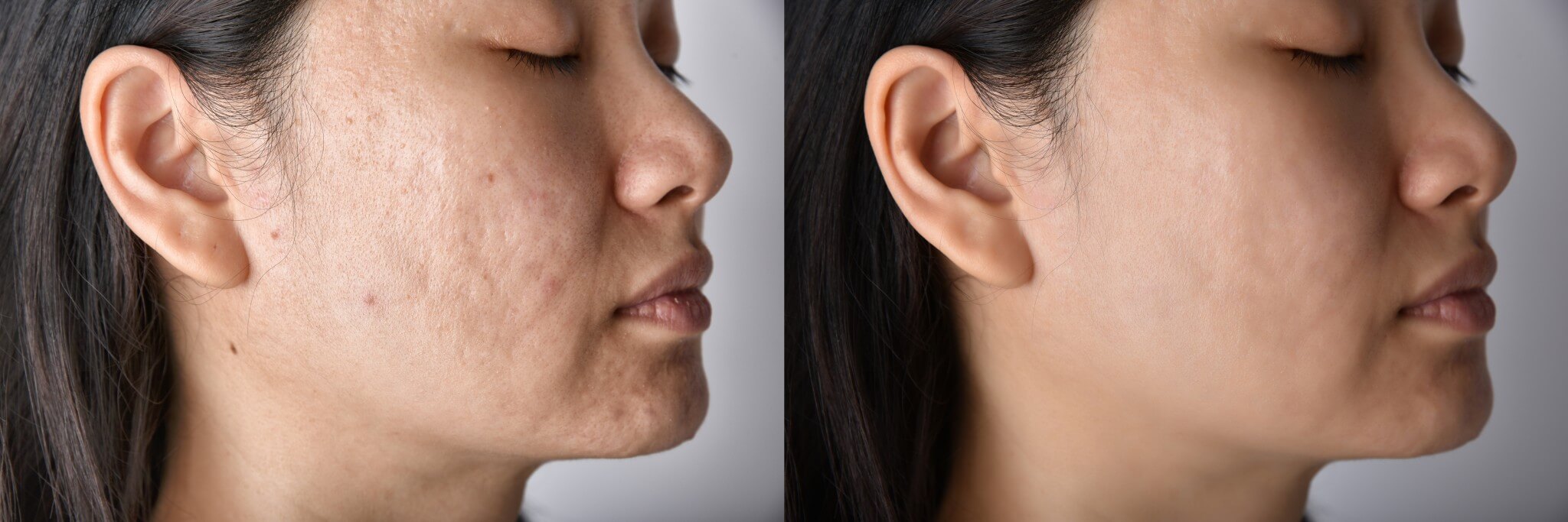 Understanding Acne Scars - Reviva Labs