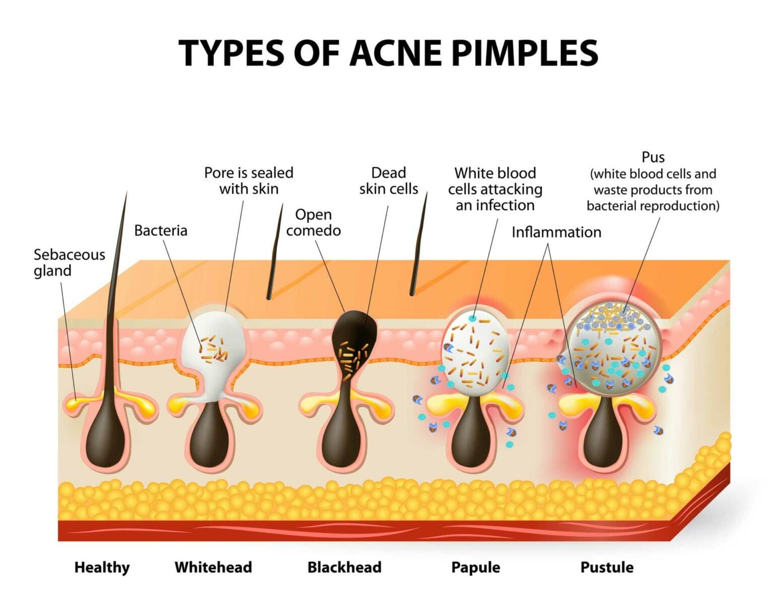 The Anatomy of a Pimple - Reviva Labs