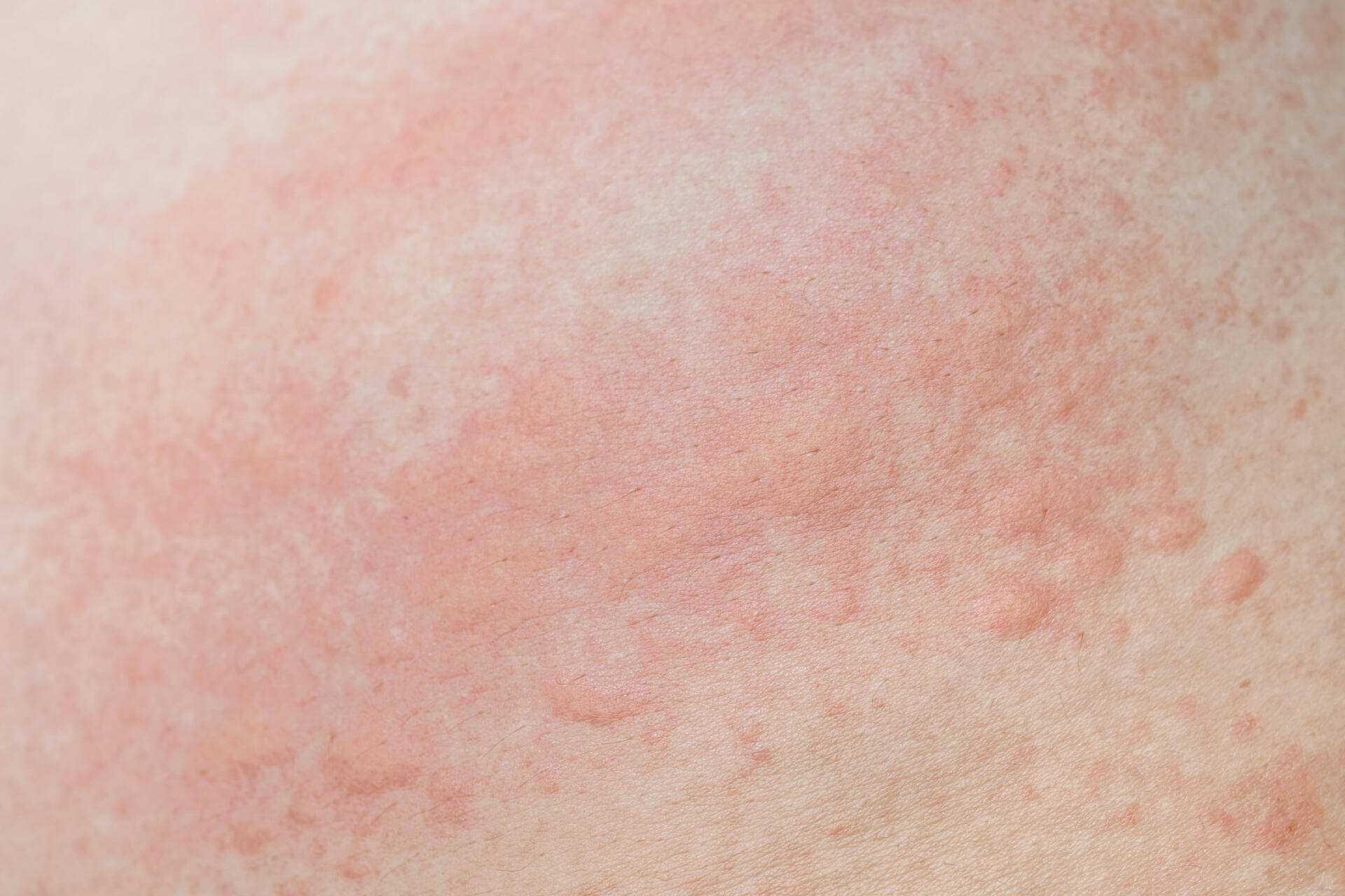 Understanding Skin Redness - Reviva Labs