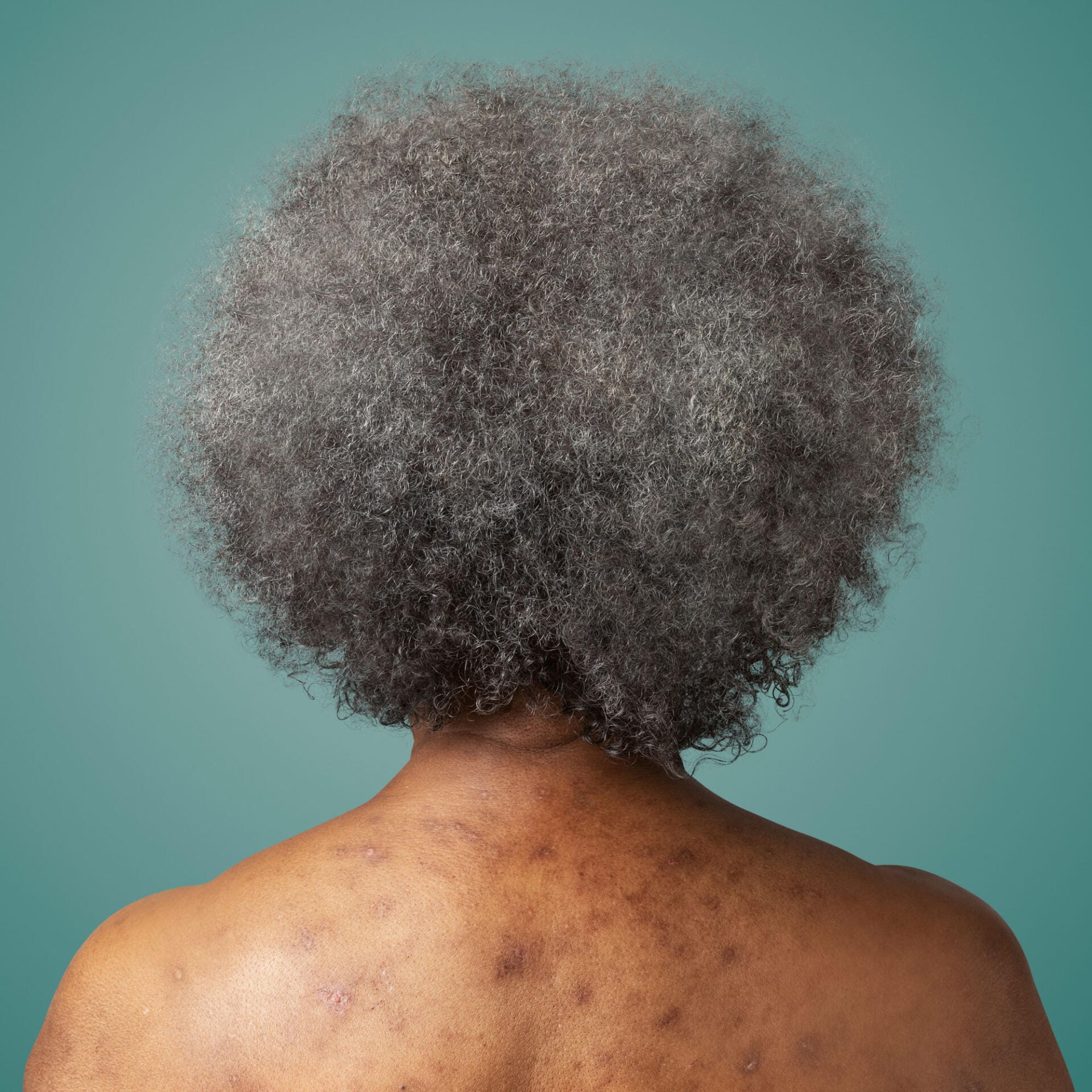 Treat Skin Discoloration, such as Hemosiderin, with Topical Vitamin K