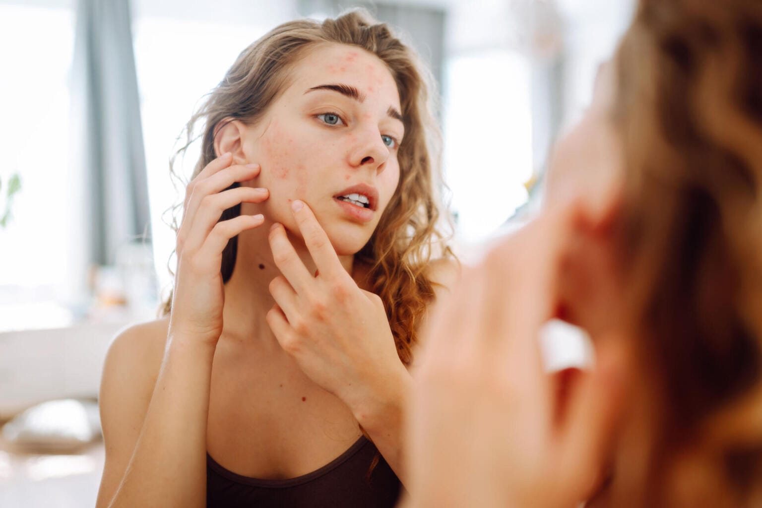 Top Ingredients to Fight Acne & Clear Blemishes!