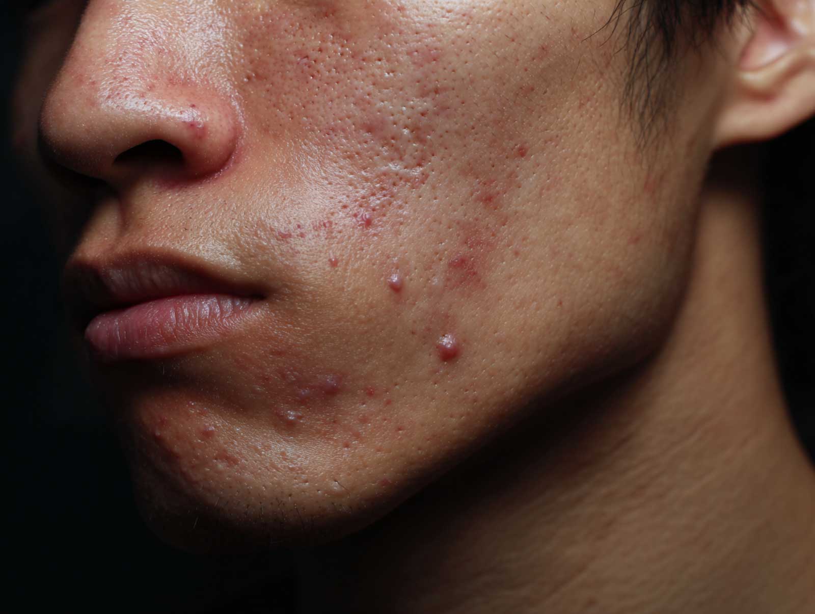 Understanding Cystic Acne: More Than Just Breakouts