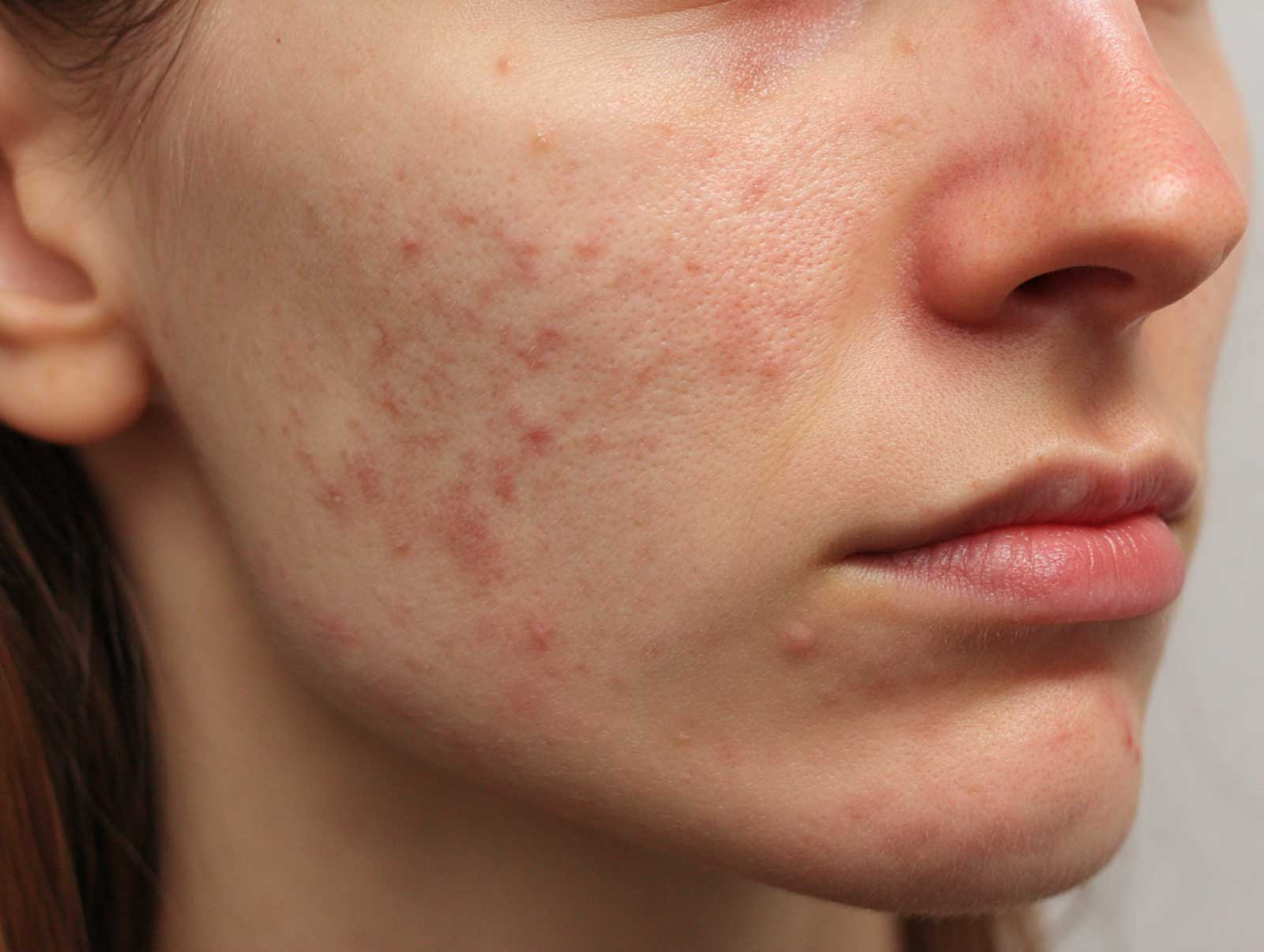 Understanding Cystic Acne: More Than Just Breakouts